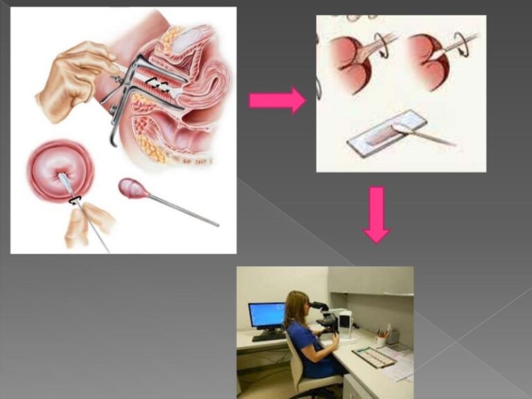 La prueba de Papanicolaou: Una herramienta esencial para la salud femenina